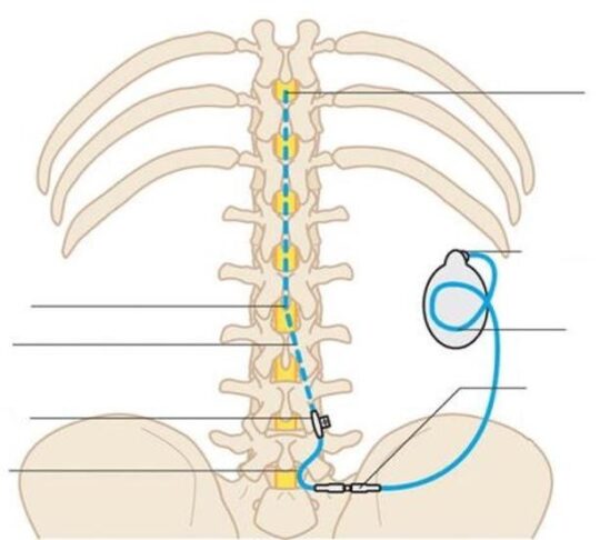 Bombas de infusão de fármacos totalmente implantáveis